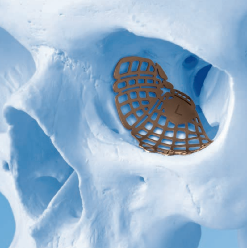 [안와골절] 안와골절의 진단 및 치료 : 네이버 블로그