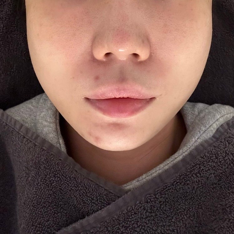 코모공레이저 청담 피부과 모공클리닉 포텐자 1회차 후기 네이버 블로그