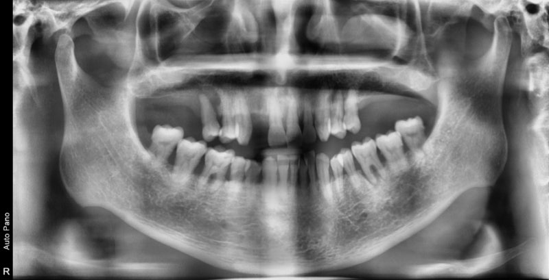 앞니 임플란트 잘하는치과, 이빨사이잇몸부터 다릅니다.(feat. creeping attachment '2탄') : 네이버 블로그