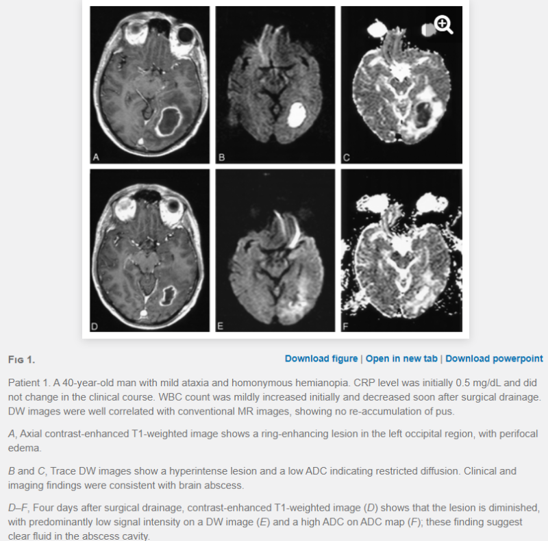 Brain abscess (뇌 농양) 진단 및 치료 : 네이버 블로그