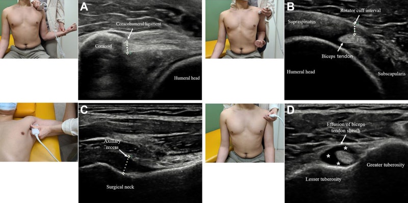 오십견 frozen shoulder의 진단 axillary recess thickness CHL 초음파검사 : 네이버 블로그