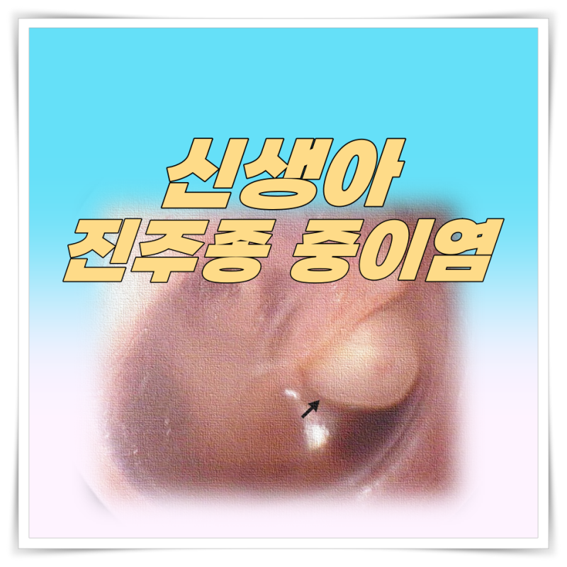 신생아 아기 진주종 수술 진주종성 중이염 네이버 블로그