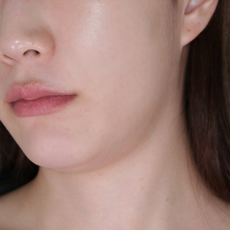 인모드 FX + Forma 효과 본 후기 (+강남언니) : 네이버 블로그