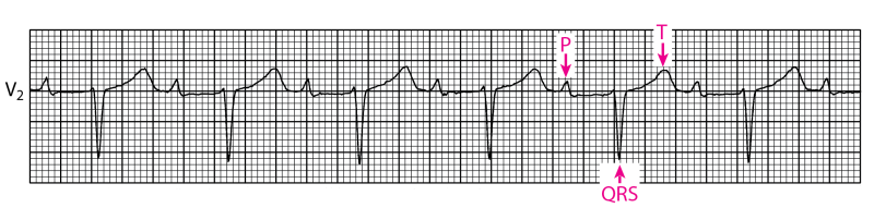 심전도, 이상 심전도, 심장질환, STEMI, NSTEMI, AV block, 12 lead EKG 장착 : 네이버 블로그