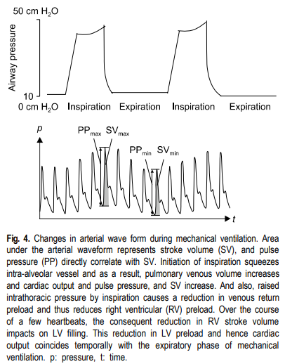 Fluid response를 확인하기 위해 PPV, SVV를 측정하는 이유와 수동하지거상(passive Leg elevation ...
