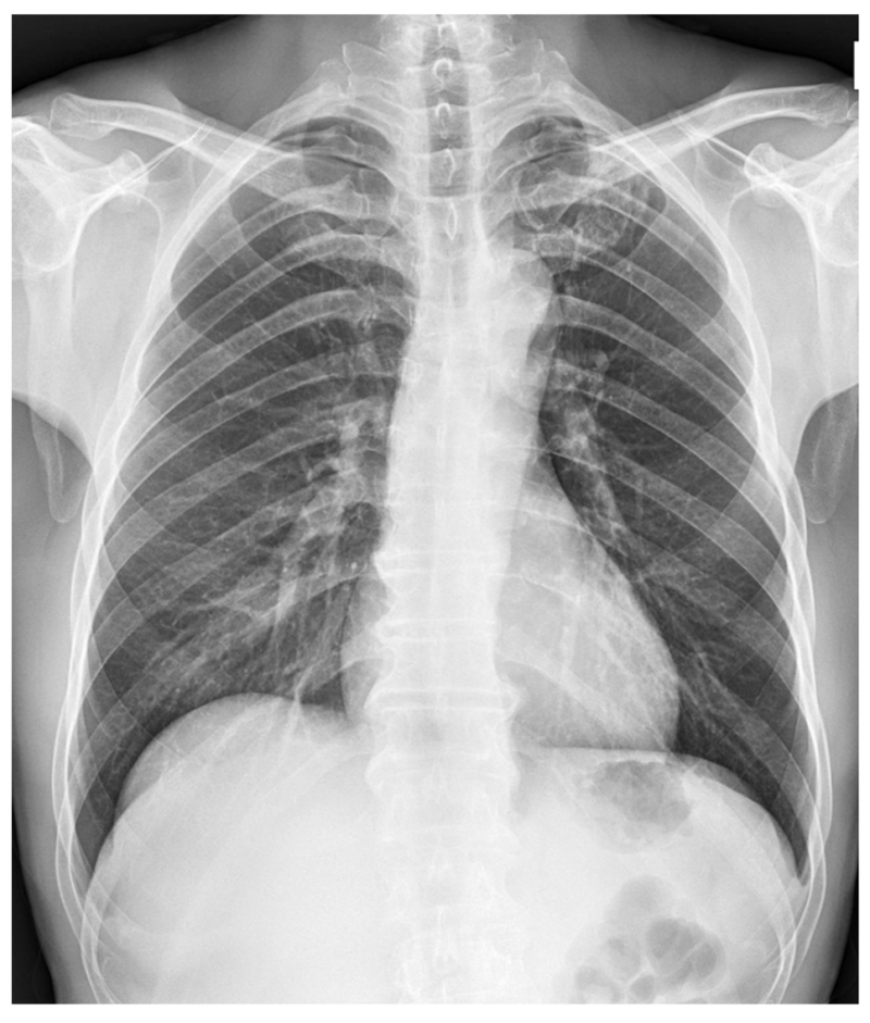 비활동성 결핵 폐엑스레이 증례 흉부x선 사진 석회화결절 Calcified Nodule 섬유화 네이버 블로그
