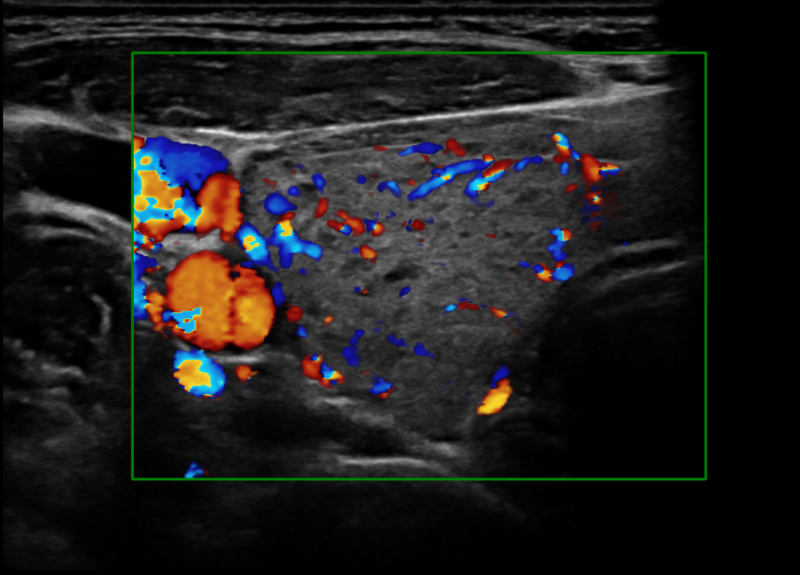 [Hashitoxicosis Case] 갑상선항진증으로 발현된 하시모토 갑상선염 임상경과, 진단 및 치료 정리 : 네이버 블로그