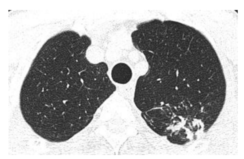비활동성 결핵 폐엑스레이 증례 흉부x선 사진 석회화결절 Calcified Nodule 섬유화 네이버 블로그