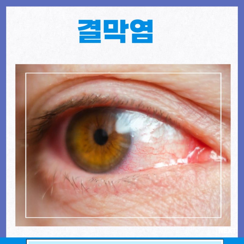 유행성 결막염 증상 전염 치료 알레르기 결막염 눈병 증상 네이버 블로그