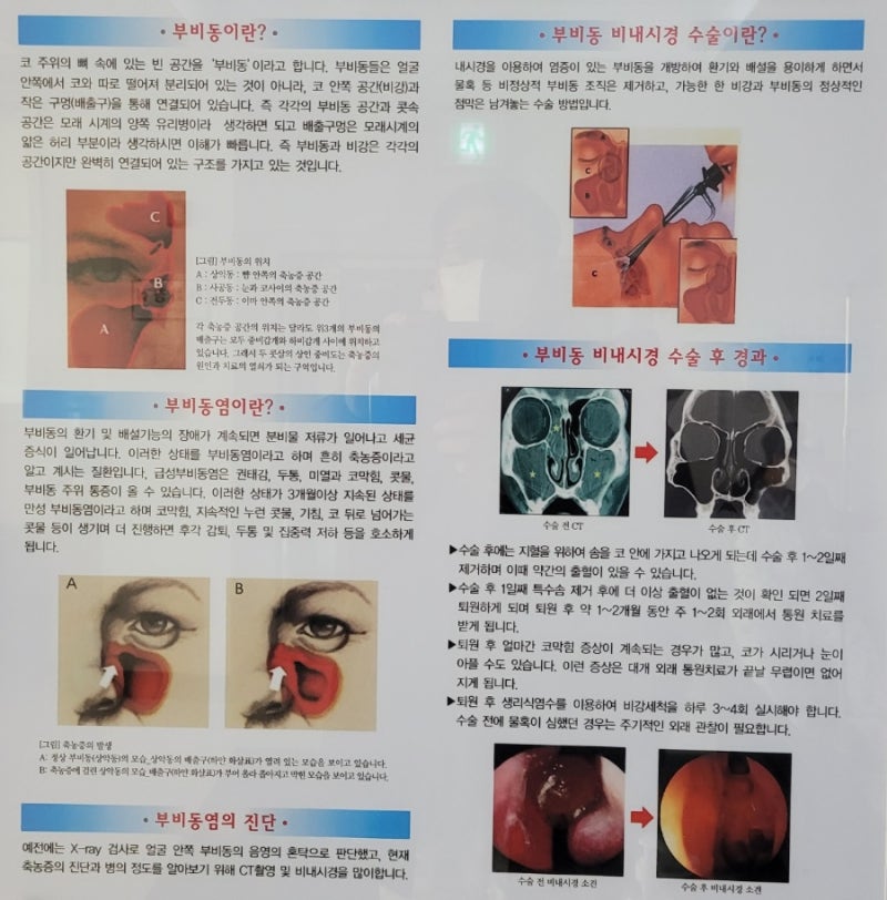 비중격교정술 비염 축농증수술 후기입원 수술 퇴원 생생후기 이정도면 뭐 너무 걱정할 것 없다 네이버 블로그