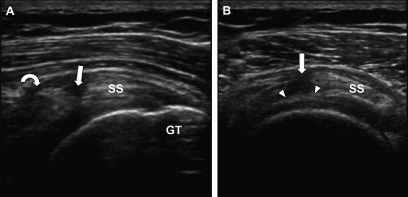 [Rotator cuff]Supraspinatus tendon tears and tendinosis : 네이버 블로그