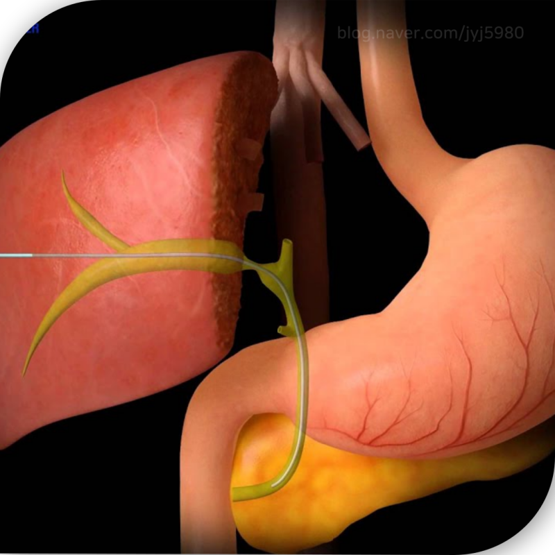 의학용어 ERCP와 담도 배액술 PTBD PTGBD ENBD ERBD : 네이버 블로그