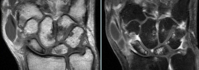 [손목] Scapholunate dysfunction & SLAC wrist : 네이버 블로그