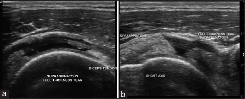 [Rotator cuff]Supraspinatus tendon tears and tendinosis : 네이버 블로그