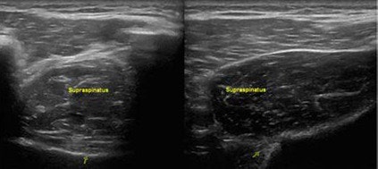 [Rotator cuff]Supraspinatus tendon tears and tendinosis : 네이버 블로그