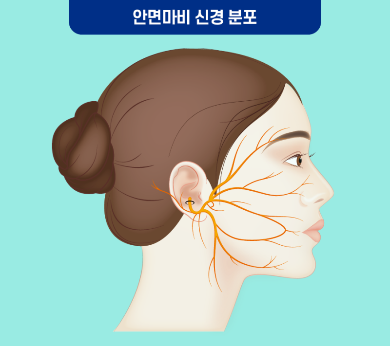 놓치면 후회하는 구안와사안면마비 초기증상과 치료 골든타임 네이버 블로그