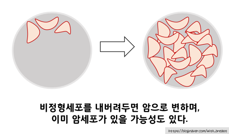 유방양성질환 관내유두종 섬유선종 엽상종 방사형 반흔 경화성 선증 물혹 비정형세포 네이버 블로그