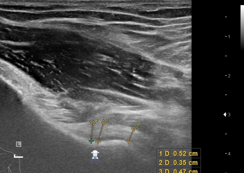 오십견 frozen shoulder의 진단 axillary recess thickness CHL 초음파검사 : 네이버 블로그