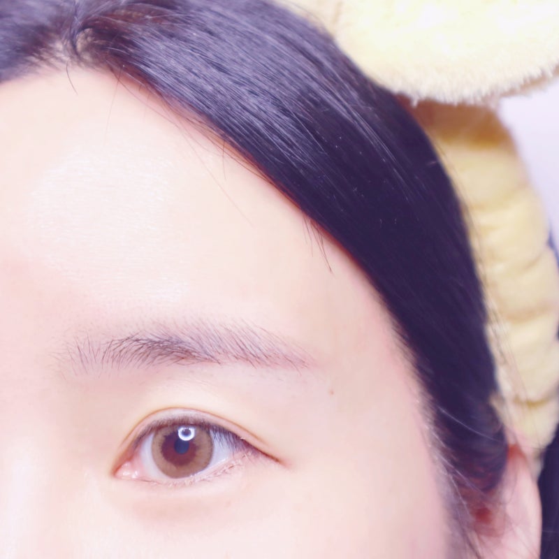 다이소 여드름 압출기 및 바늘 활용한 짜기 짜고난후 관리 네이버 블로그