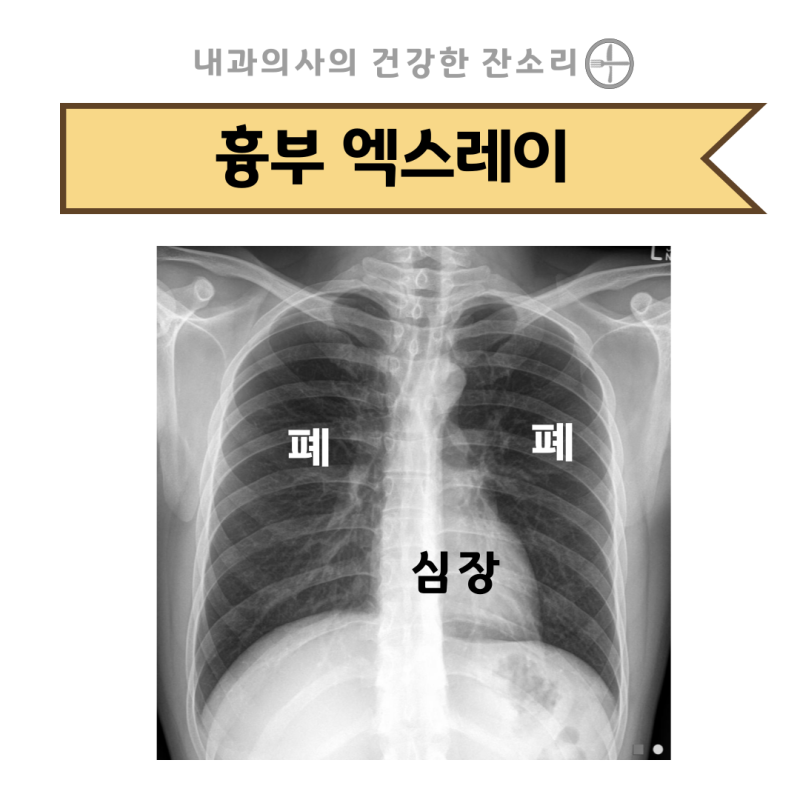 제 폐엑스레이 사진이 지저분하다고요 흡연자의 흉부 사진 네이버 블로그