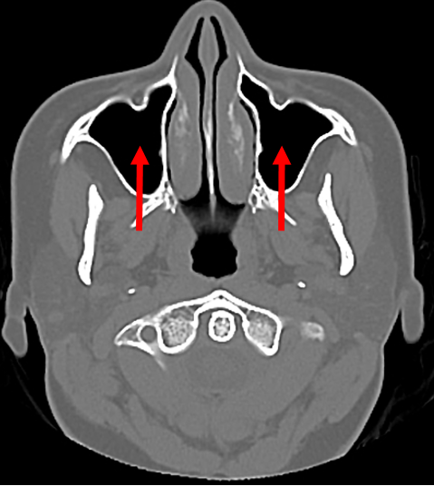 상악동 저류낭종(maxillary sinus retention cyst) : 네이버 블로그