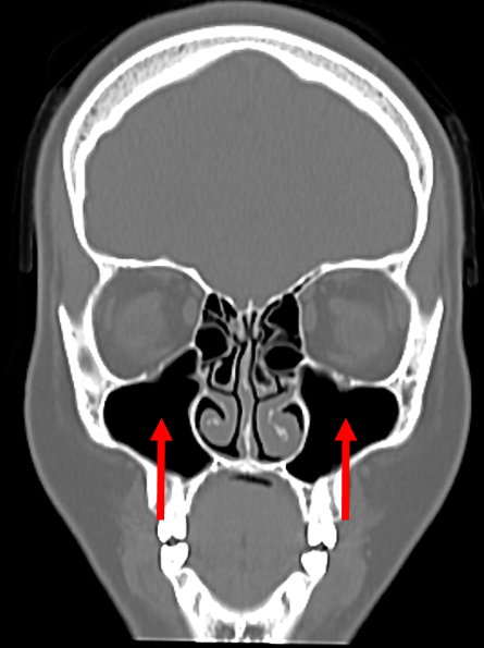 상악동 저류낭종(maxillary sinus retention cyst) : 네이버 블로그