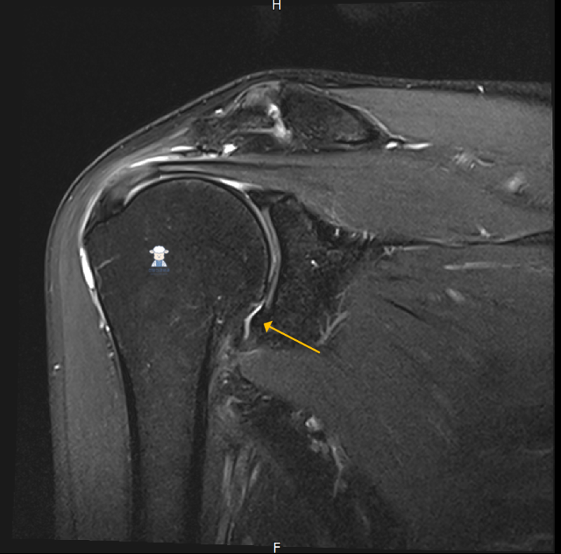 오십견 frozen shoulder의 진단 axillary recess thickness CHL 초음파검사 : 네이버 블로그