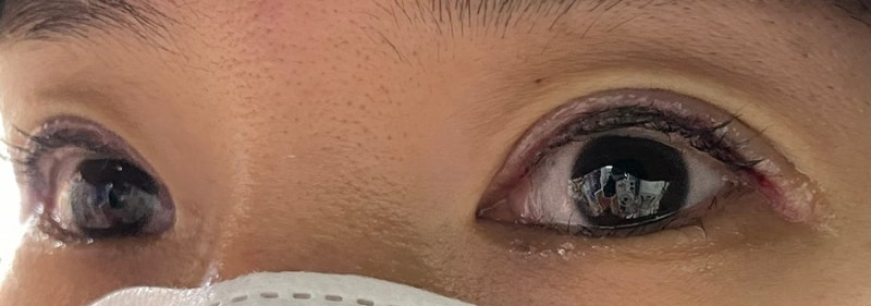 아이라인 반영구 제거 아이라인 1차 문신제거 일주일 후기 마취주사 레이저 시술 아프다 네이버 블로그