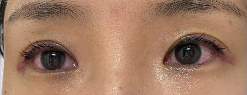 아이라인 반영구 제거 아이라인 1차 문신제거 일주일 후기 마취주사 레이저 시술 아프다 네이버 블로그