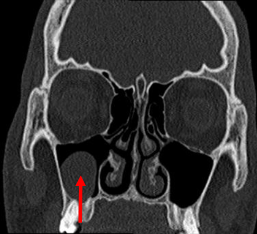 상악동 저류낭종(maxillary sinus retention cyst) : 네이버 블로그