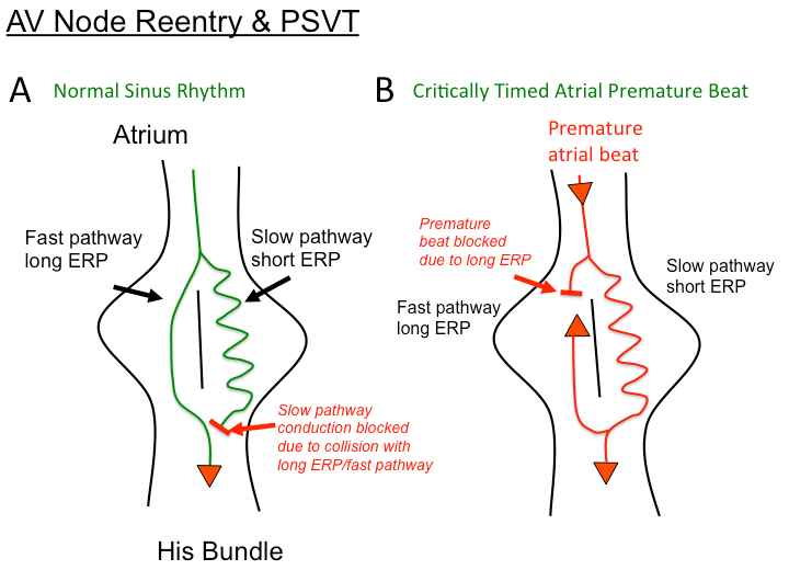 PSVT(발작성 상심실성 빈맥) 유형 1 AVNRT(방실결절 회귀성빈맥, AV nodal reentry tachycardia ...