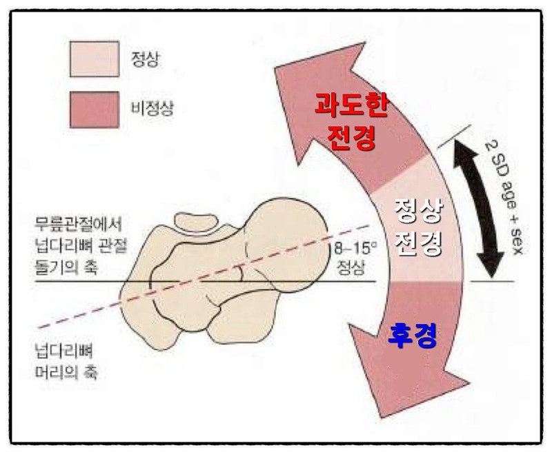 안짱다리(Toe in)와 팔자걸음(Toe out) 원인, 검사 : 전경(Anteversion), 후경(Retroversion ...