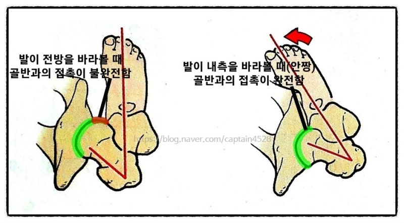 안짱다리(Toe in)와 팔자걸음(Toe out) 원인, 검사 : 전경(Anteversion), 후경(Retroversion ...