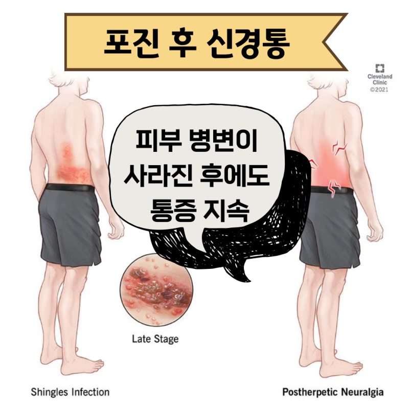 싱그릭스 대상 포진 예방할 수 있다면 싱그릭스 효과 부작용 접종 방법 비용 네이버 블로그
