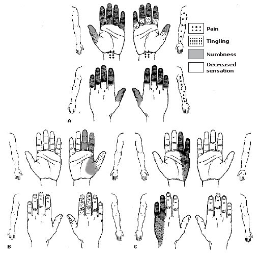 Carpal tunnel syndrome (수근관 증후군) : 네이버 블로그