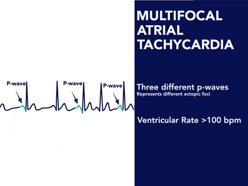 심전도로 보는 부정맥[17] - 다소성 심방 빈맥[Multifocal Atrial Tachycardia][약혐 주의] : 네이버 블로그