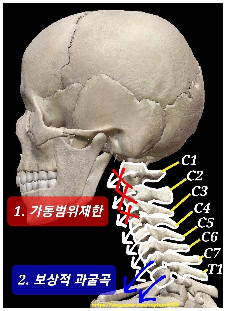 날개뼈 통증 날개죽지 통증 목뒤통증이 원인 인자 네이버 블로그