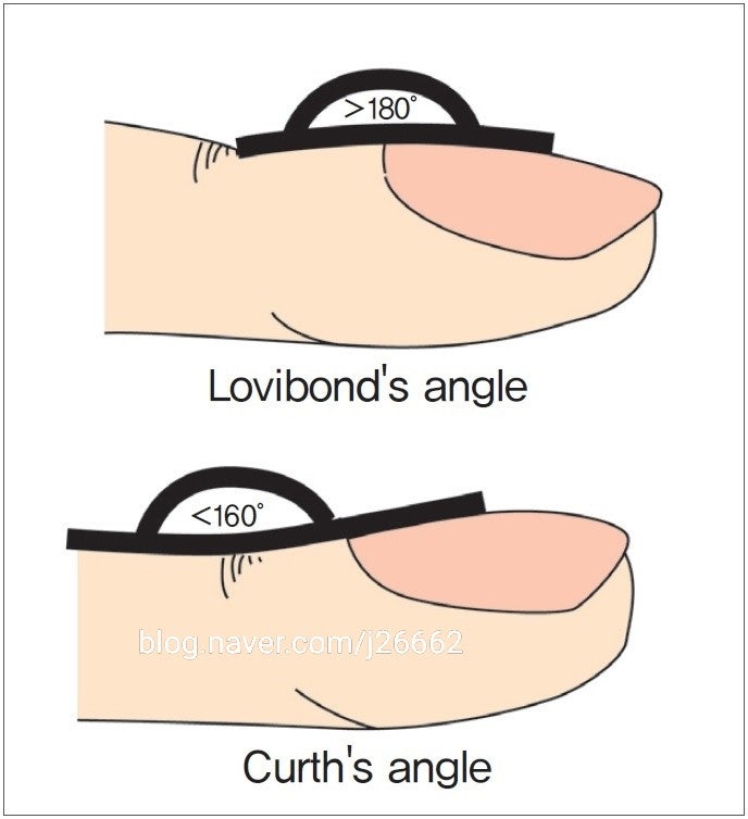 3. 곤봉손발톱(Clubbing nail) : 네이버 블로그
