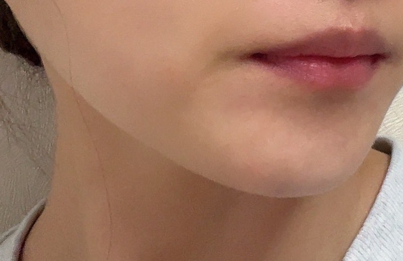 다섯가지 레이저 듀얼토닝 후기 기미 잡티 제거 레이저 효과 네이버 블로그