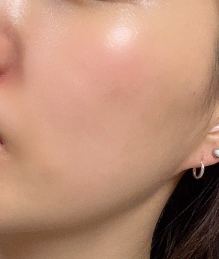 다섯가지 레이저 듀얼토닝 후기 기미 잡티 제거 레이저 효과 네이버 블로그