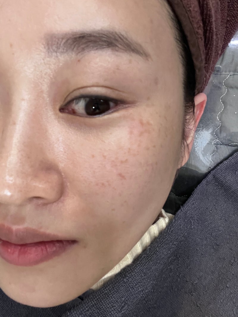 루비레이저 후기 노원역피부과 레이저토닝 발산피부과 네이버 블로그