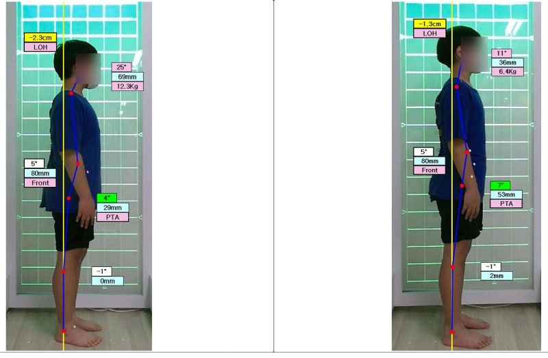 소아비만 어린이 다이어트 초등학생 평균 몸무게 관리 사례 네이버 블로그