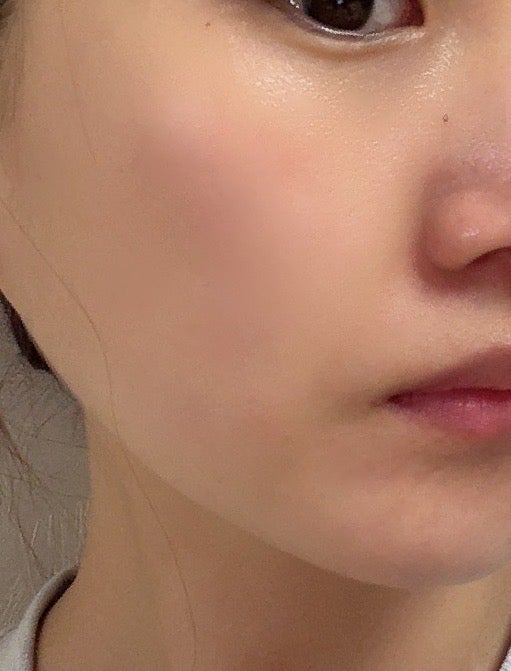 다섯가지 레이저 듀얼토닝 후기 기미 잡티 제거 레이저 효과 네이버 블로그