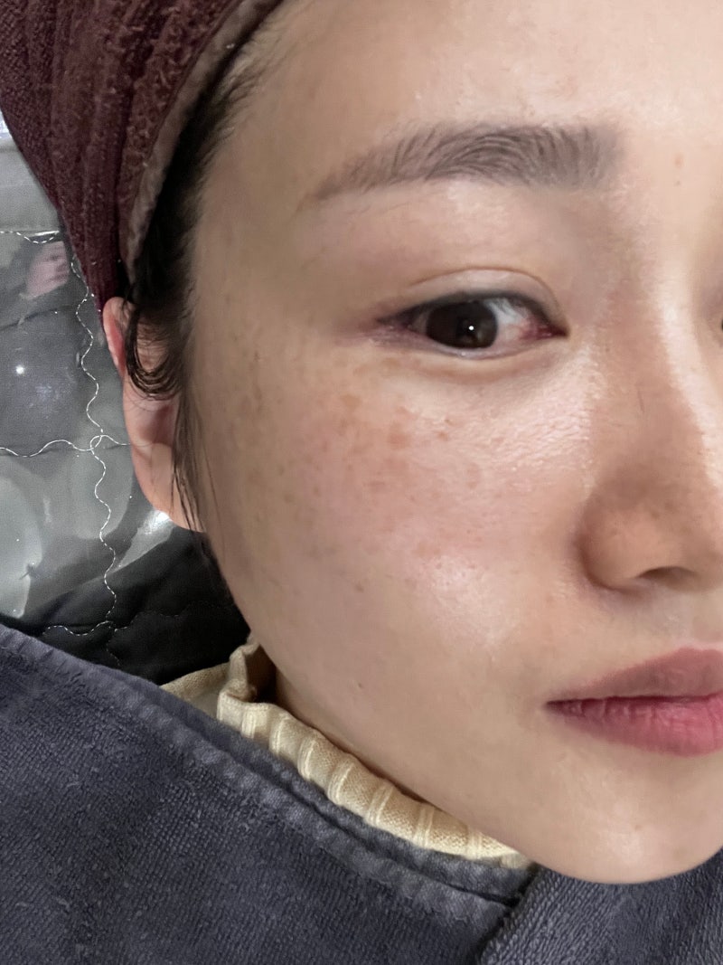루비레이저 후기 노원역피부과 레이저토닝 발산피부과 네이버 블로그