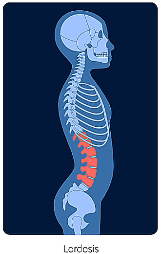 Lordosis 개선을 통한 '골반중립'으로 척추건강을 지키자 : 네이버 블로그