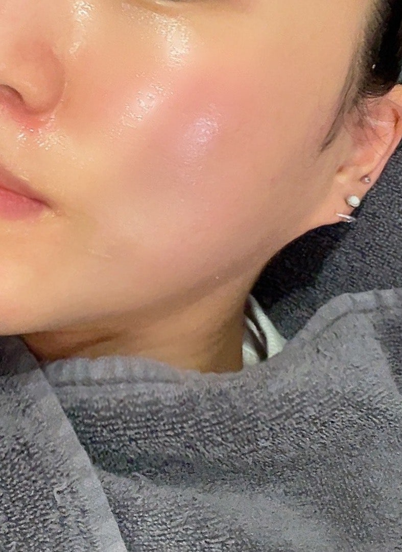다섯가지 레이저 듀얼토닝 후기 기미 잡티 제거 레이저 효과 네이버 블로그