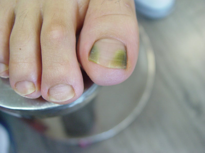 7. 녹색손발톱(Green nail syndrome / Chloronychia : 네이버 블로그