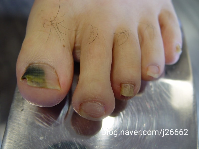 7. 녹색손발톱(Green nail syndrome / Chloronychia : 네이버 블로그