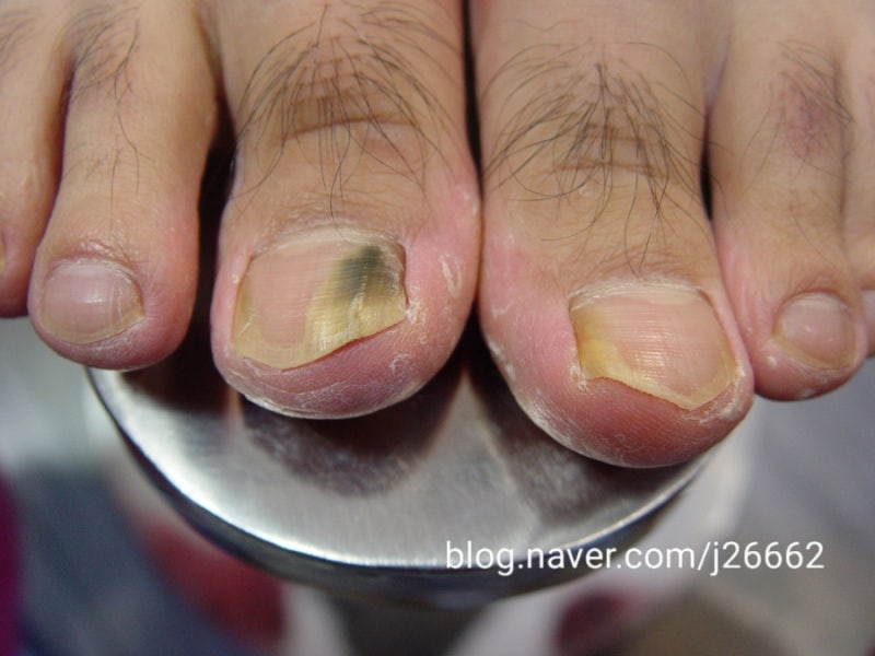 7. 녹색손발톱(Green nail syndrome / Chloronychia : 네이버 블로그
