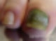 7. 녹색손발톱(Green nail syndrome / Chloronychia : 네이버 블로그